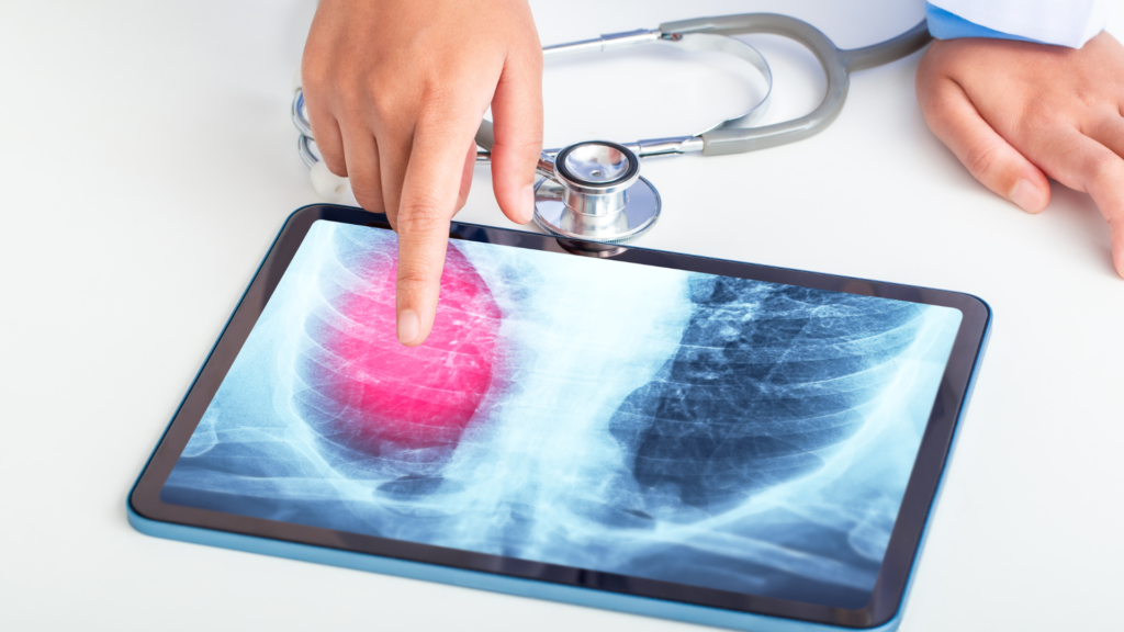 Inhaling Silica Dust | Lung Cancer Awareness